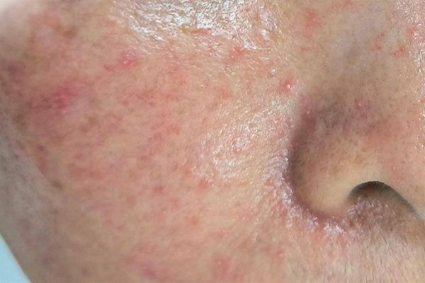 Làm thế nào để phục hồi da sau peel an toàn và nhanh chóng? – Men Stay ...