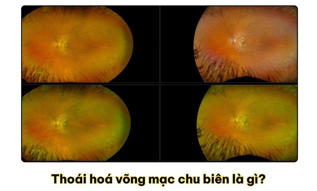Thoái hoá võng mạc chu biên: Nguyên nhân, cách điều trị