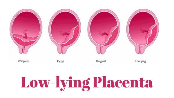 5 dangerous placental diseases that need special attention ivfholymothers