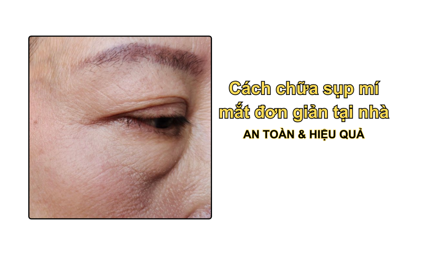 5 Cách chữa sụp mí mắt đơn giản tại nhà AN TOÀN & HIỆU QUẢ